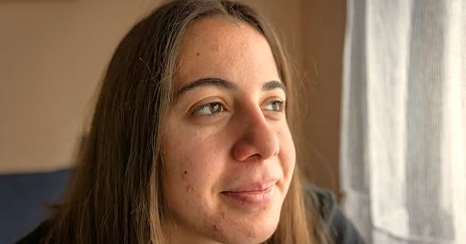 3 Reasons Acne Can Happen - Cassandra Bankson