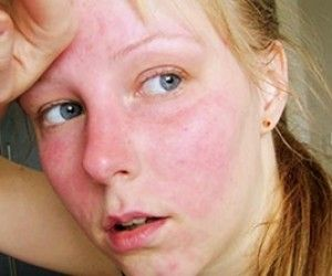 5 Reasons for Facial Redness - Cassandra Bankson